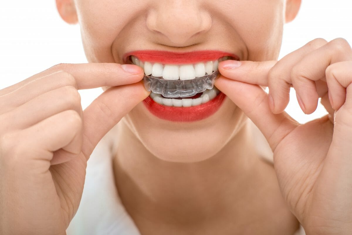 Invisalign is a Clear Aligner Therapy for Straighter Teeth